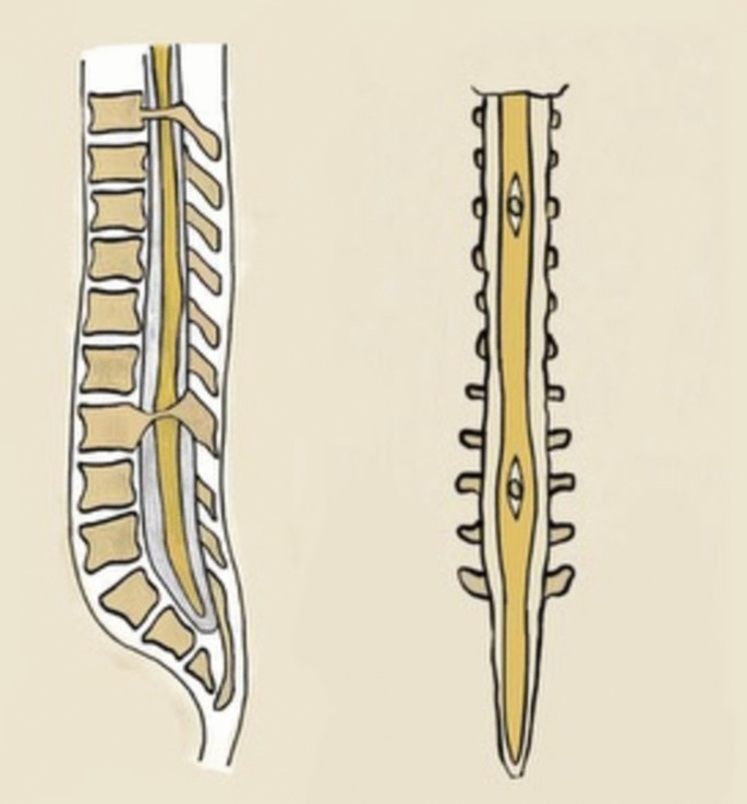 Composite type split cord malformation: a two-center study and analysis ...