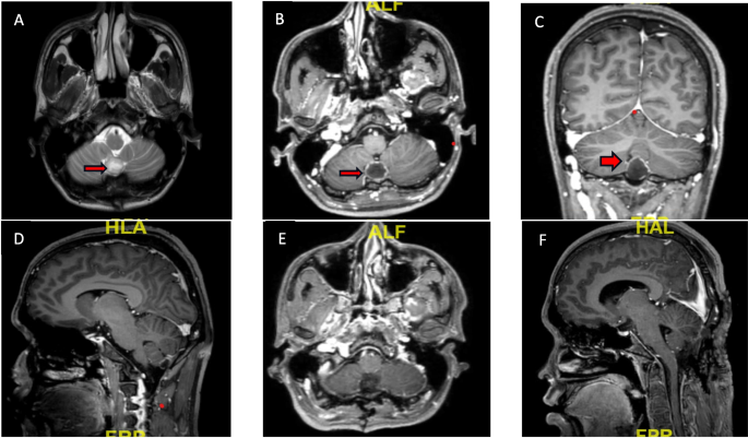 Paediatric infected intracranial dermal sinus presenting with vermian ...
