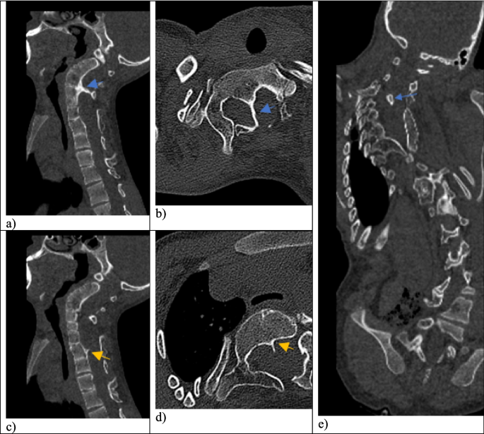 A rare case of composite dual cervical split cord malformation—a case ...