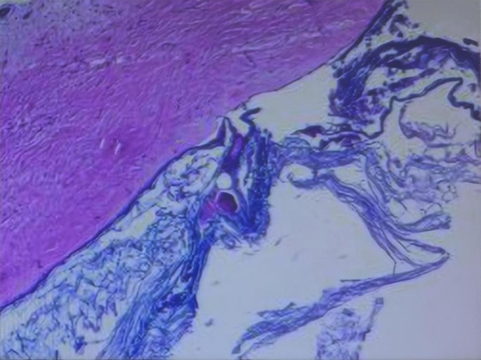 Clinical analysis of 23 cases of epidermoid cyst of testis in children ...