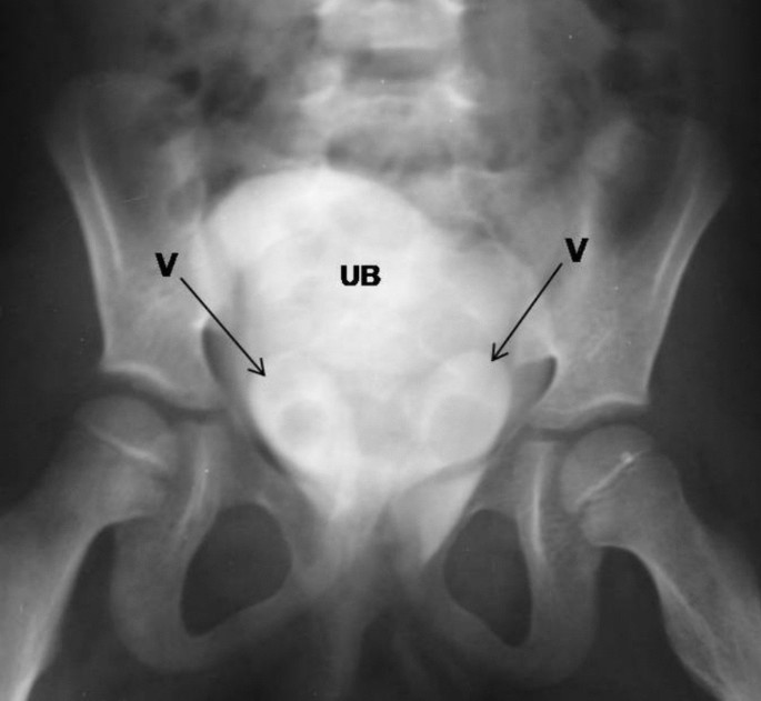 Management of urinary incontinence in girls with congenital pouch colon ...