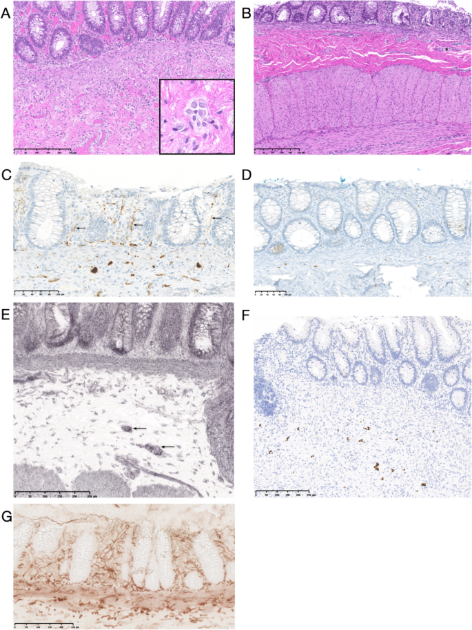 Enough is enough: how many rectal suction biopsies do you need to ...