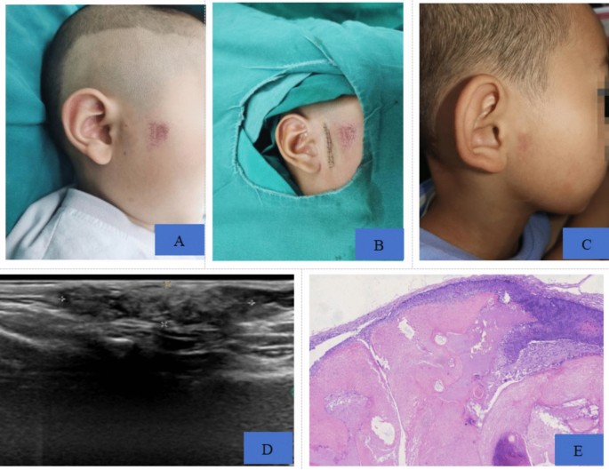 Clinical features and surgical management of pilomatrixoma in children ...
