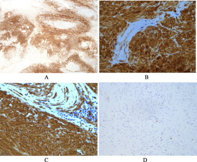Angioleiomyoma originating from the ano-rectal wall presenting as a ...
