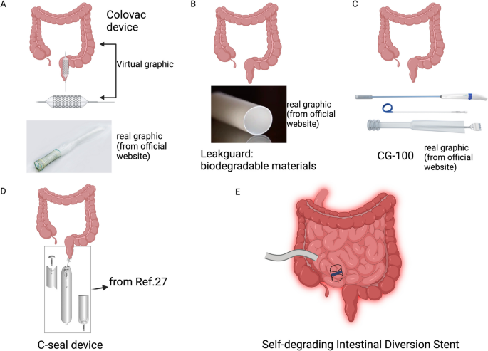 Advanced innovations in reducing anastomotic leak: a review of emerging ...