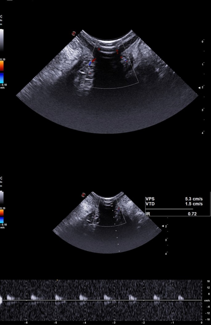 Arterial flow in healthy individuals and patients with hemorrhoidal ...