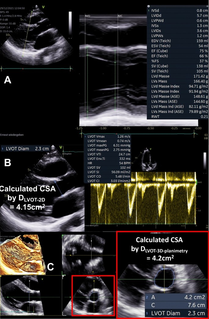 Echocardiographic assessment of left ventricular volumes: a comparison ...