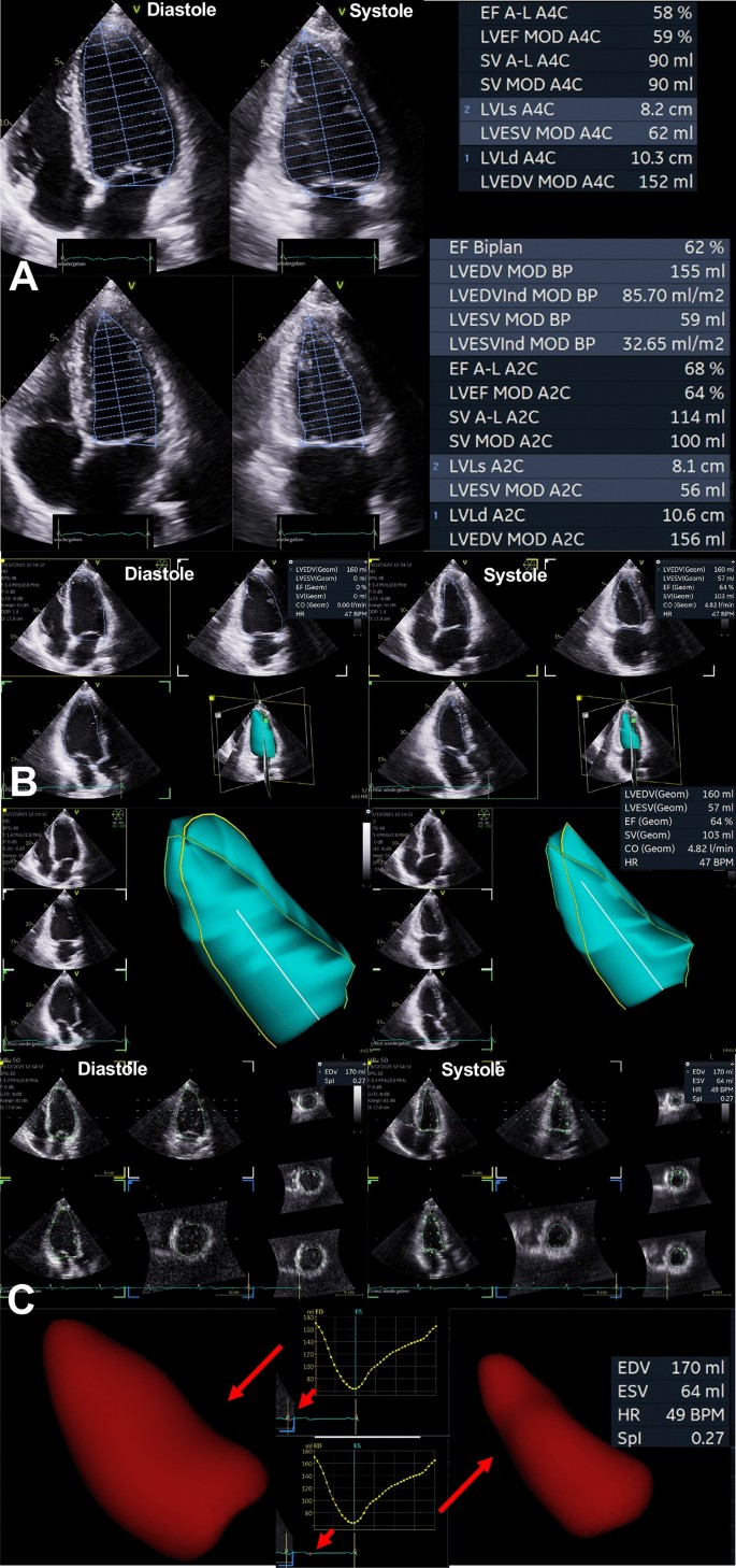 Echocardiographic assessment of left ventricular volumes: a comparison ...