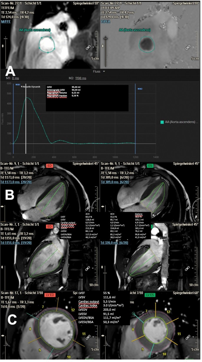 Echocardiographic assessment of left ventricular volumes: a comparison ...