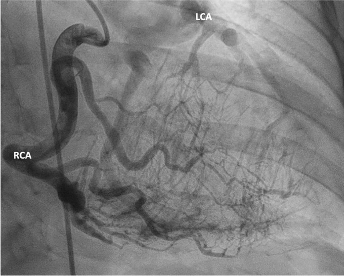 A 39-year-old women with newly diagnosed ALCAPA syndrome during ...