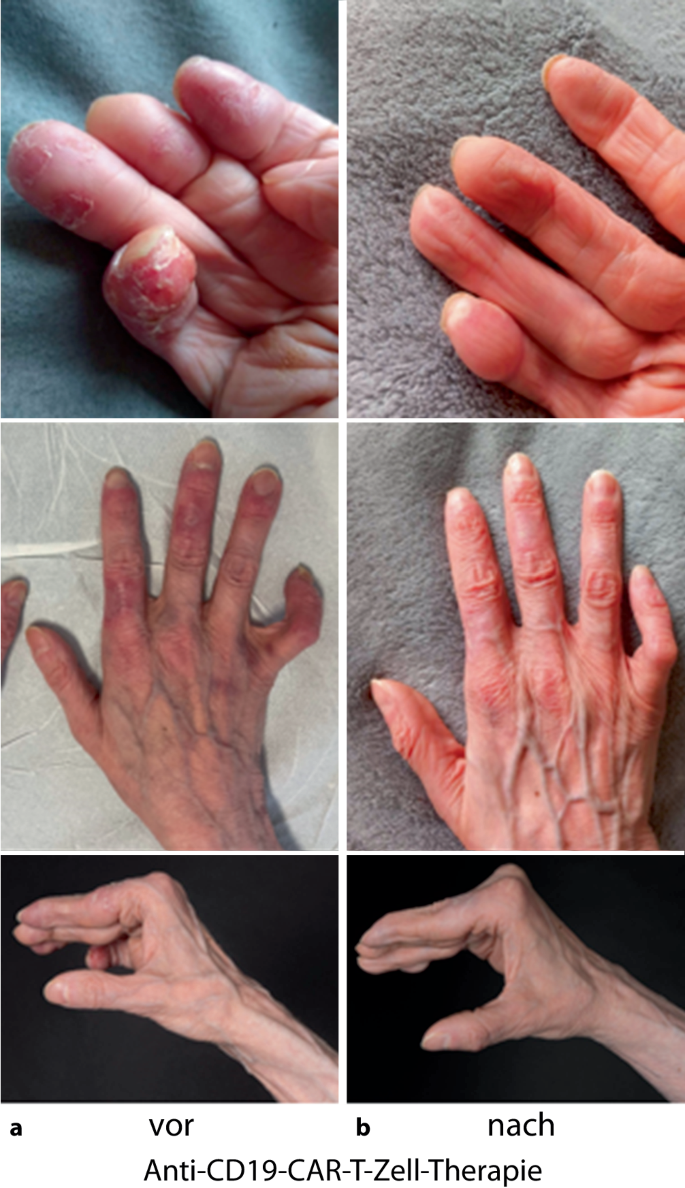 Langzeitverlauf von Effizienz und Sicherheit der CD19-CAR T-Zell ...