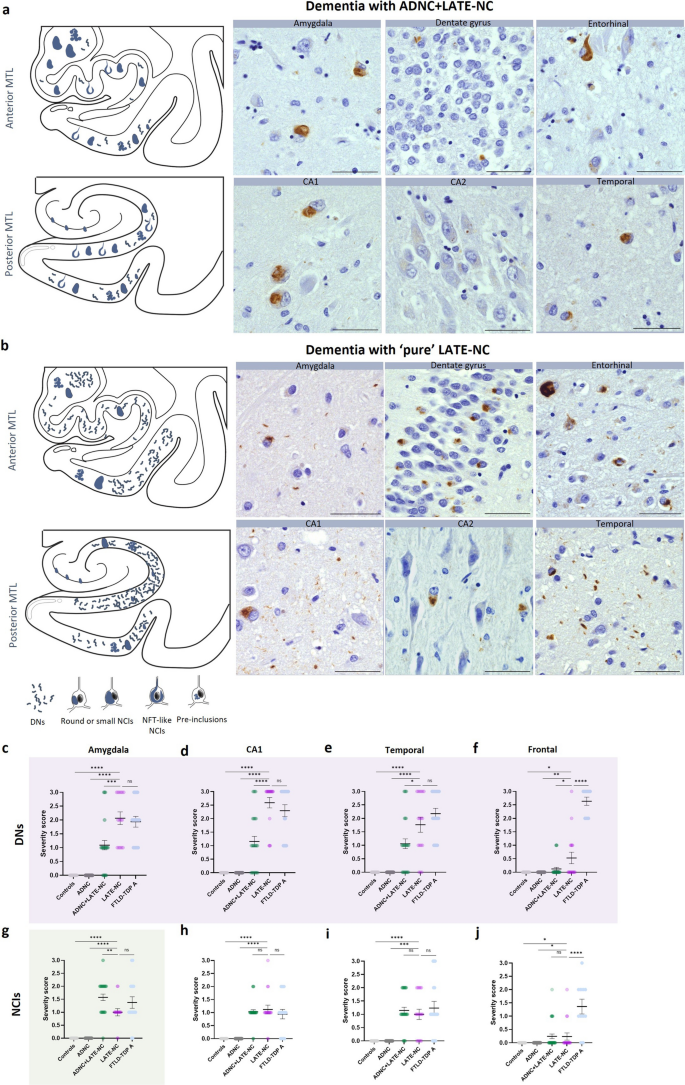 Differences and overlaps in TDP-43 pathology of ‘pure’ LATE-NC compared ...