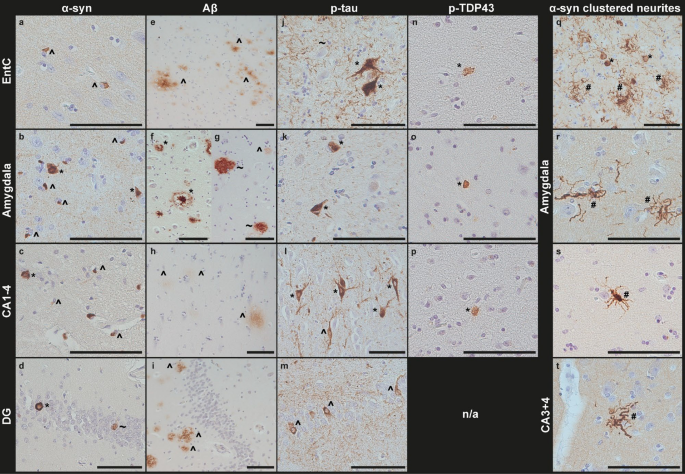 Limbic Alzheimer’s co-pathology in multiple system atrophy is ...