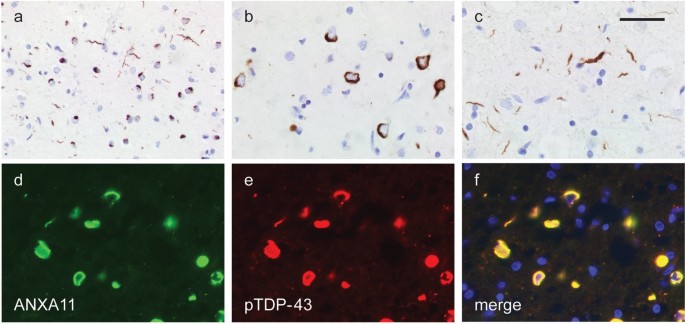 A new FTLD-TDP subtype with annexin A11 co-pathology | Acta ...