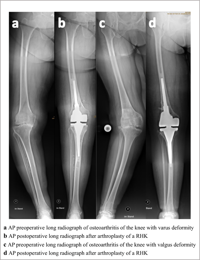 Reconstruction of mechanical leg axis using non-modular cemented hinged prosthesis in complex ...