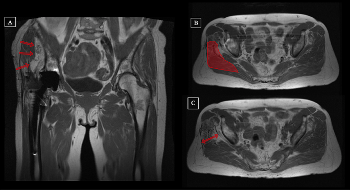 Recovery of muscular tissue and functional results of patients treated ...