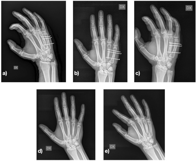 Percutaneous transverse pinning for metacarpal fractures: a clinical ...