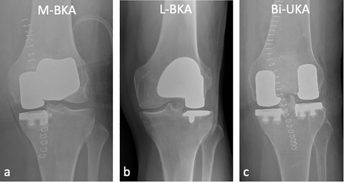 Bicompartmental Knee Arthroplasty: a systematic review and Delphi ...