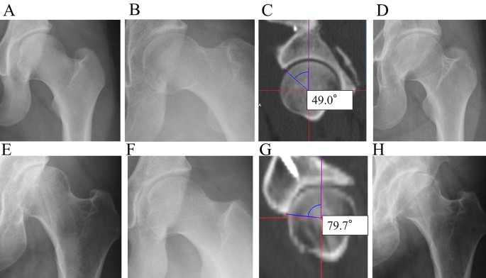 Combined assessment of acetabular coverage and femoral head-neck shapes ...