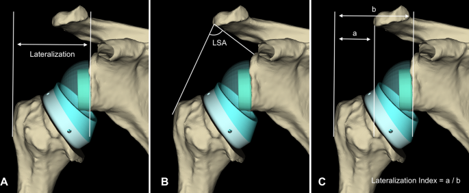 The lateralization and distalization index is more reliable than ...