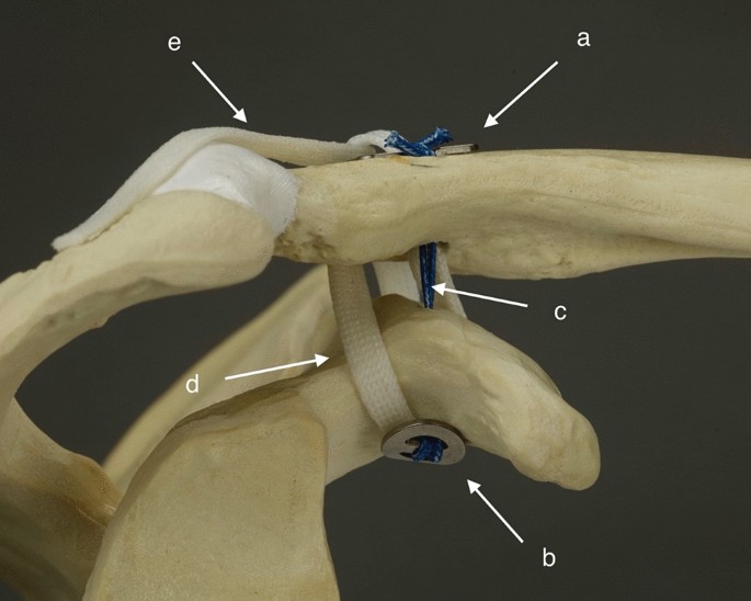 Tendon graft through the coracoid tunnel versus under the coracoid for ...