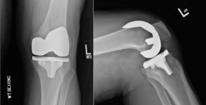 Short-term survival of the cementless triathlon total knee arthroplasty ...