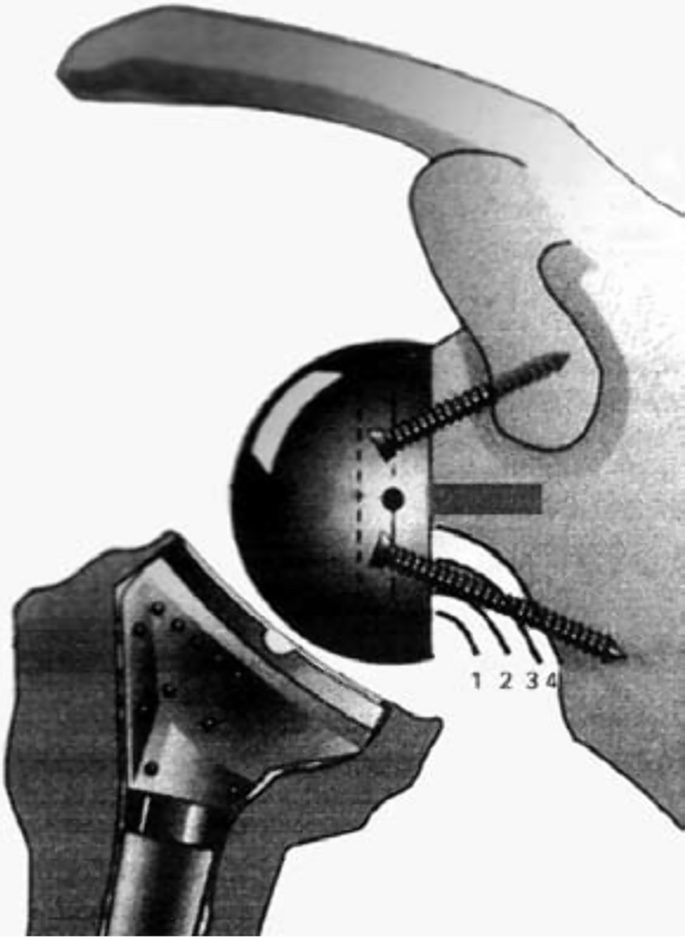 Modified notching classification in inverted-bearing and conventional ...