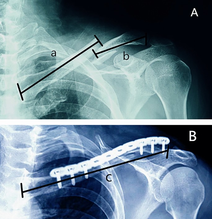 Morphologic profiles of comminuted midshaft clavicle fractures: a ...