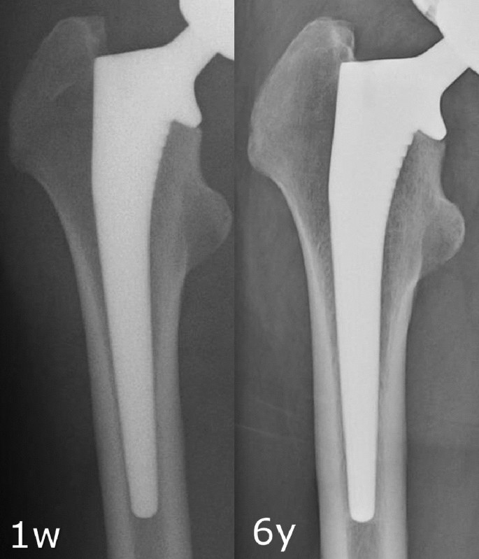 Mid-term outcomes of compaction autologous bone grafting in uncemented ...