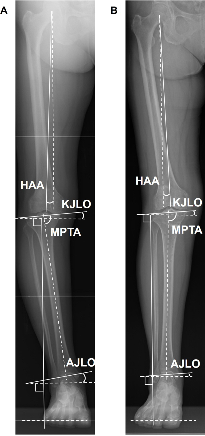 An increased medial proximal tibial angle of greater than 95 degrees ...