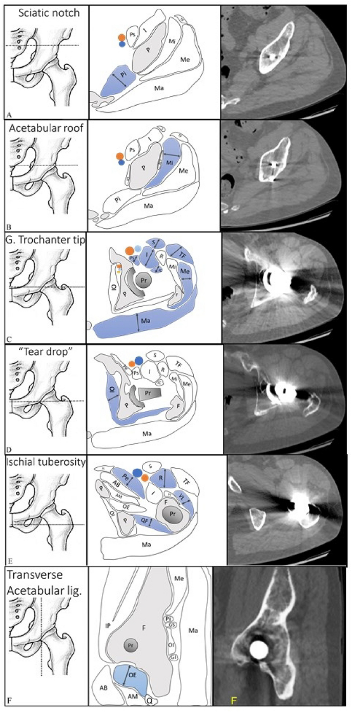 Postoperative muscle atrophy and fatty degeneration with respect to ...