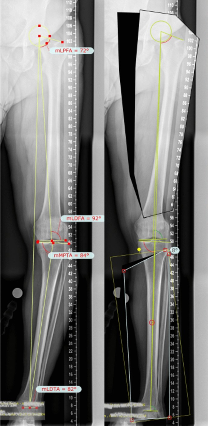Comparing the outcome after double level osteotomies in severe valgus ...
