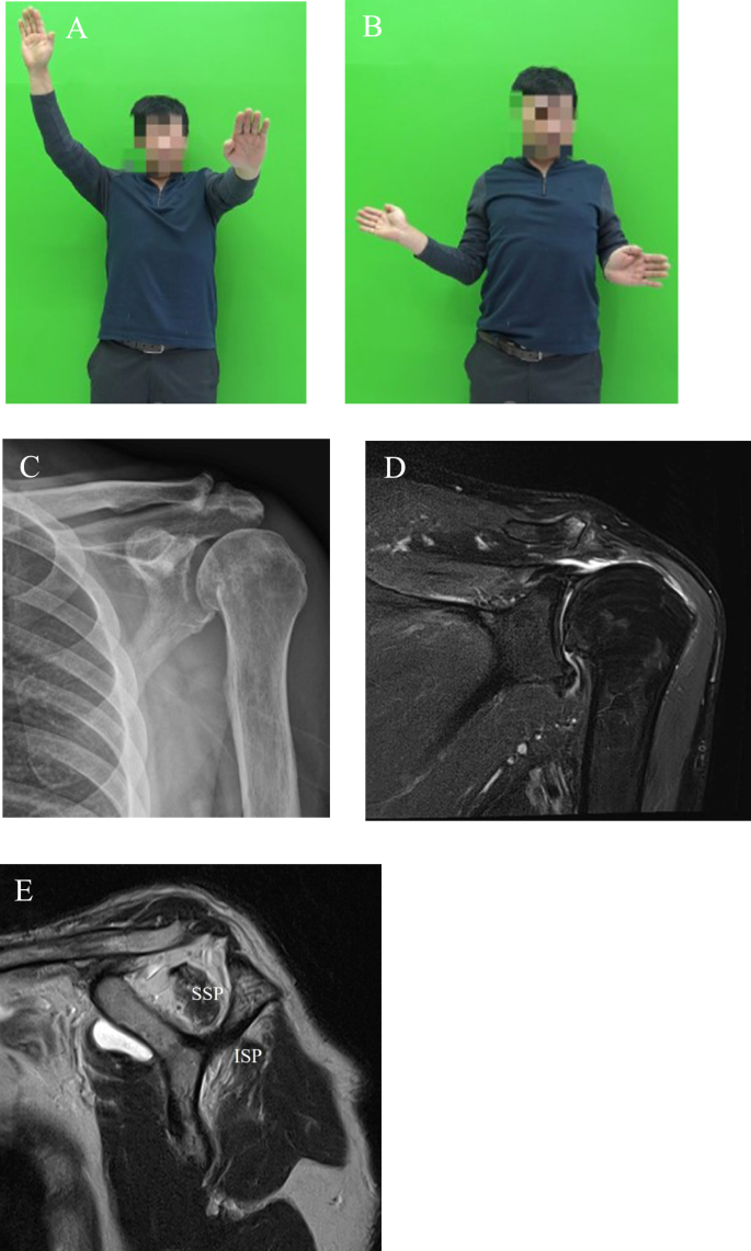 Efficacy of arthroscopic assisted lower trapezius tendon transfer versus reverse shoulder ...