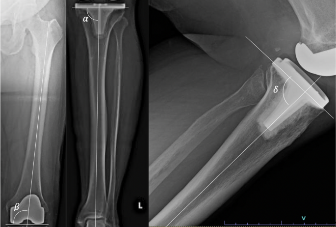 Alignment and early clinical outcomes following total knee arthroplasty ...