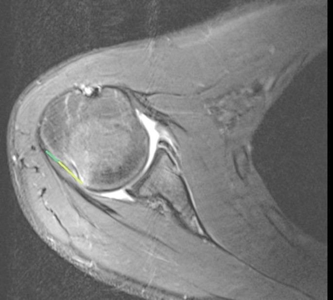 Comparison of conventional MRI and CT scans for assessing bony ...