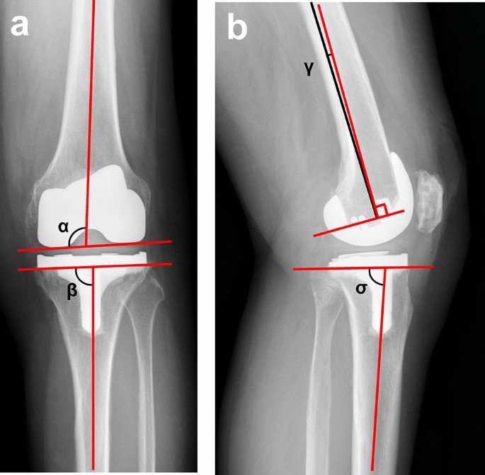 Component placement angles in total knee arthroplasty affect mid- to ...