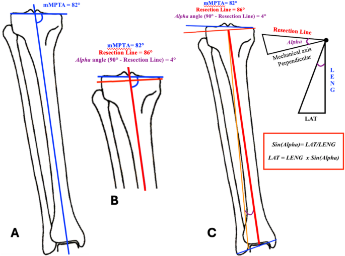 Extramedullary tibial guide orientation in TKA personalized alignment ...