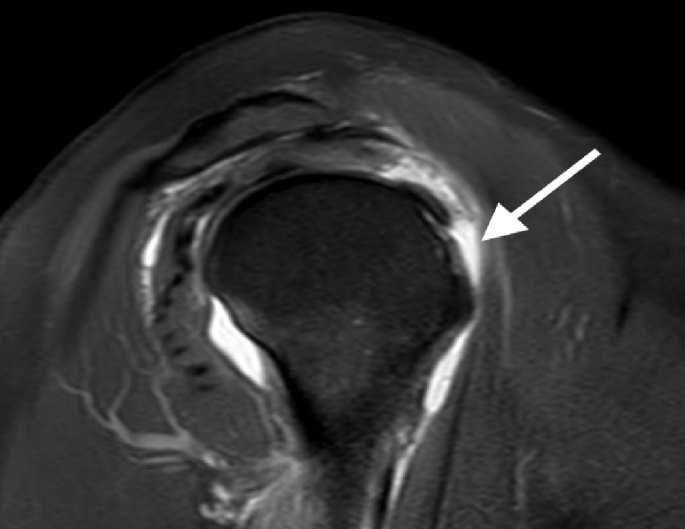 Which MRI signs truly predict subscapularis tears? A multivariate ...