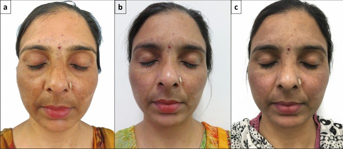 A randomized, open-label study to compare two different dosing regimens ...
