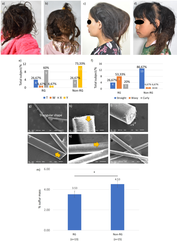 Indonesian dreadlock hair: a novel presentation of hair shaft disorders ...
