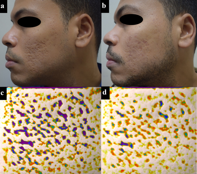 PDO screw threads versus fractional CO2 laser, after subcision, for ...