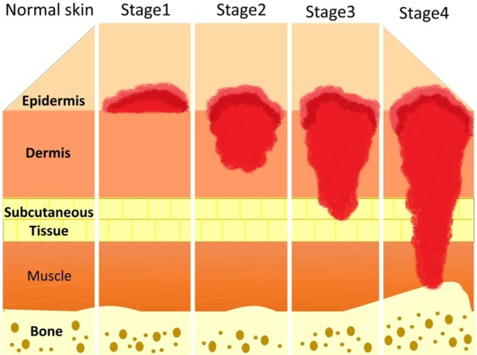 Application of novel strategies in chronic wound management with ...