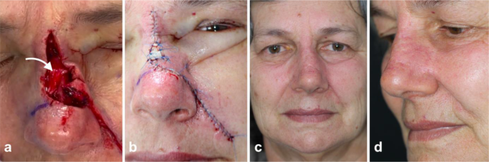 Combination of melolabial Burow’s advancement flap, muscle hinge flap ...