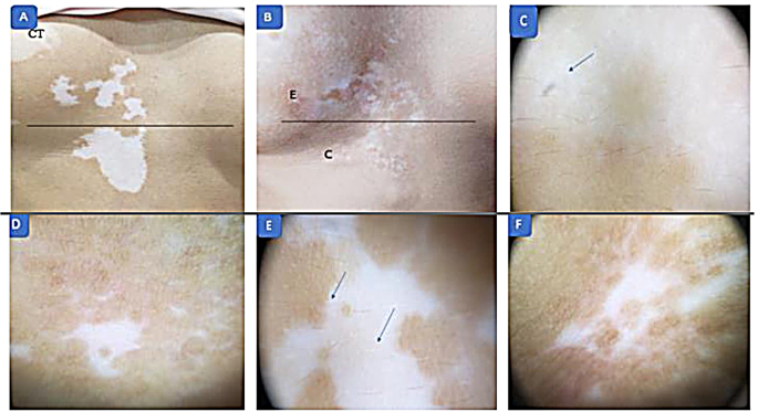 Comparative study between combined follicular and epidermal cell ...