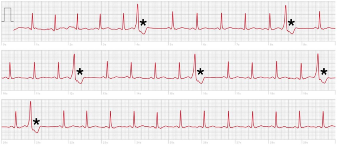 Monitoring heart rhythms in adult males with X-linked ichthyosis using ...