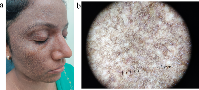 Dickkopf 1 and Neuregulin 1 as cutaneous biomarkers for dermal ...