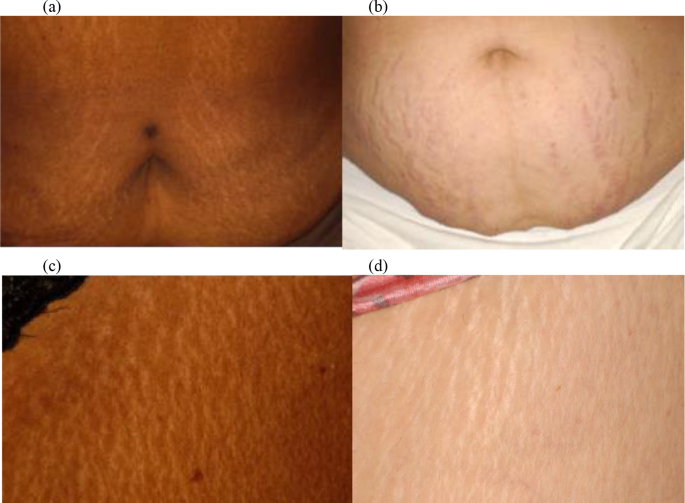 Differences in clinical features and risk factors for striae distensae ...