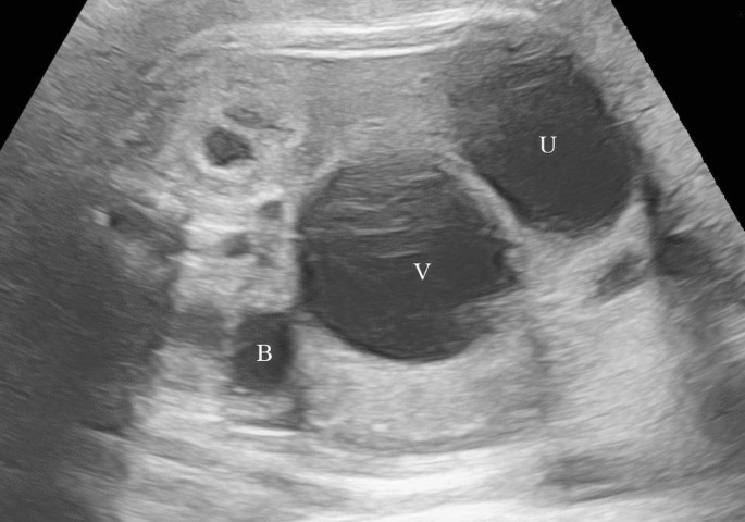 Isolated hydrometrocolpos and cloacal malformation: can we prenatally ...
