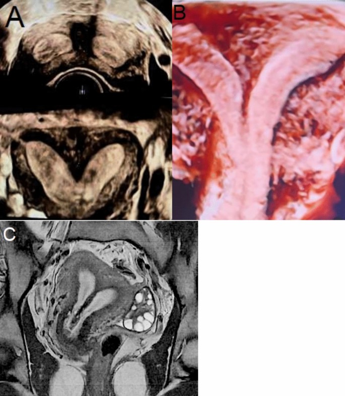 Electrosurgical hysteroscopic metroplasty for septate uterus: a single ...