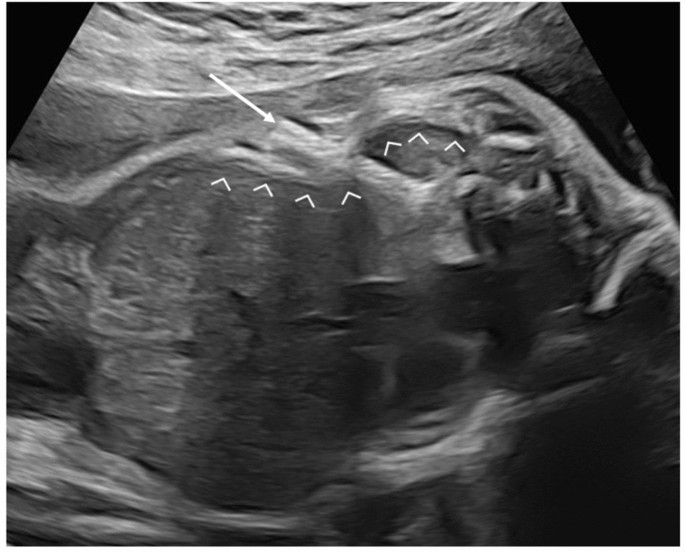 Fetal thoracoamniotic shunting for severe macrocystic congenital ...